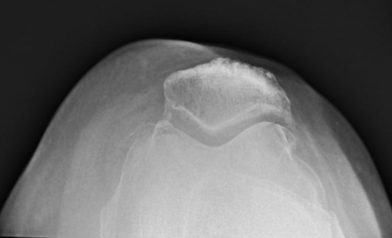 Robotic Assisted Partial Knee Replacement Darwin Chen Md 6851