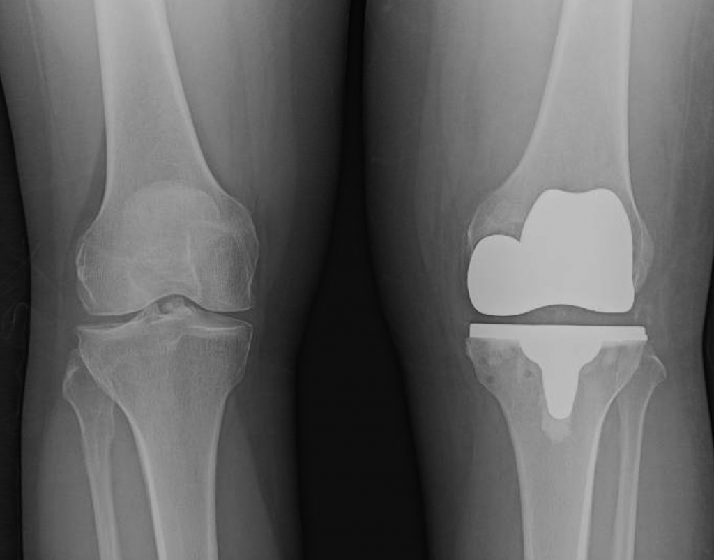 Customized TKA – Darwin Chen, MD