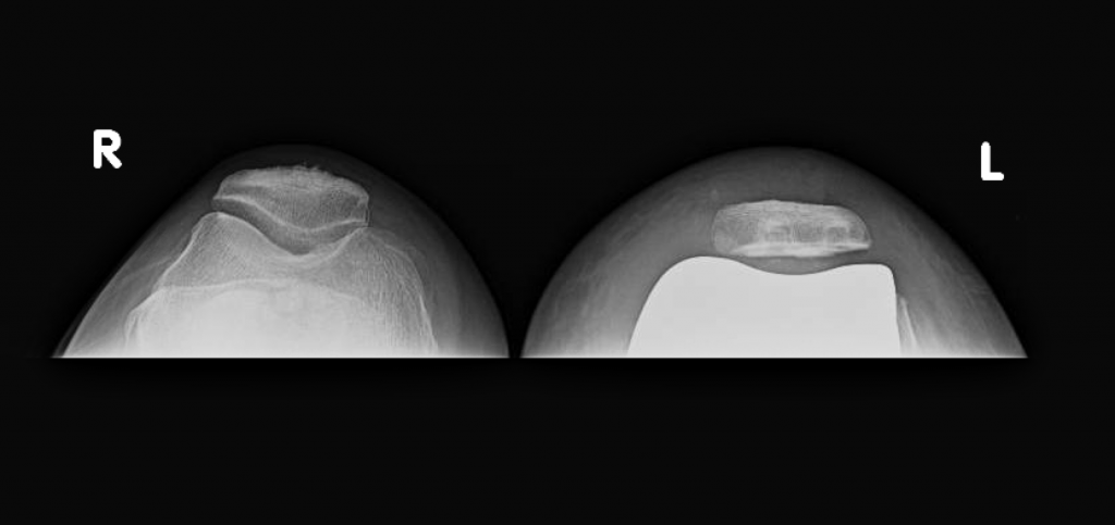 Customized TKA – Darwin Chen, MD