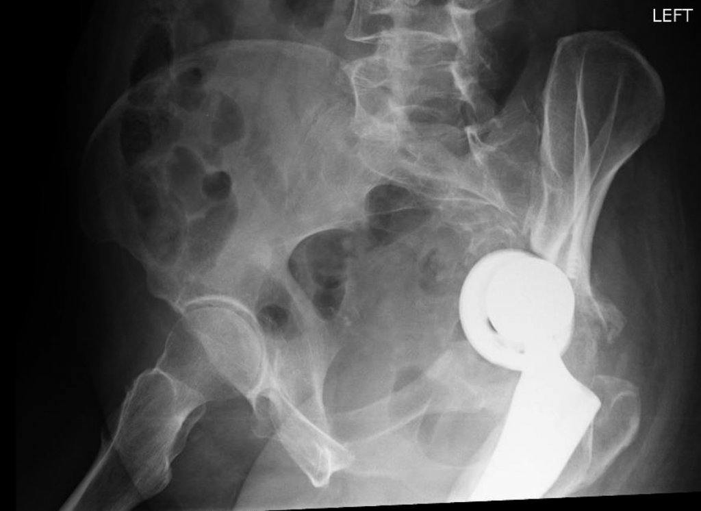 Pelvic Discontinuity – Darwin Chen, MD