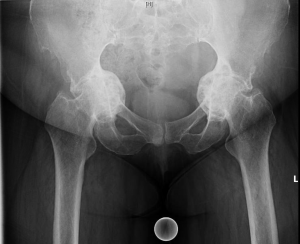 Protrusio Acetabuli – Darwin Chen, MD