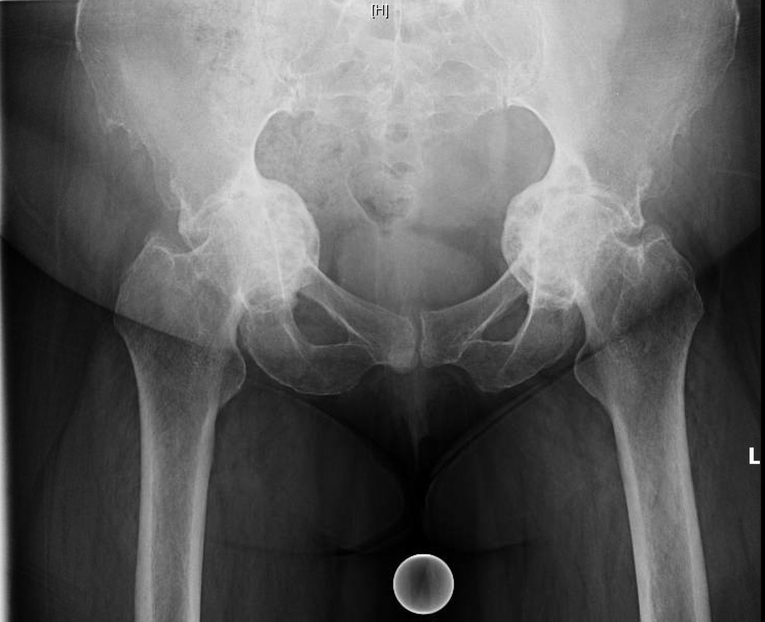 Protrusio Acetabuli – Darwin Chen, MD