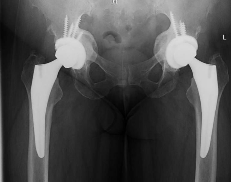Protrusio Acetabuli – Darwin Chen, MD