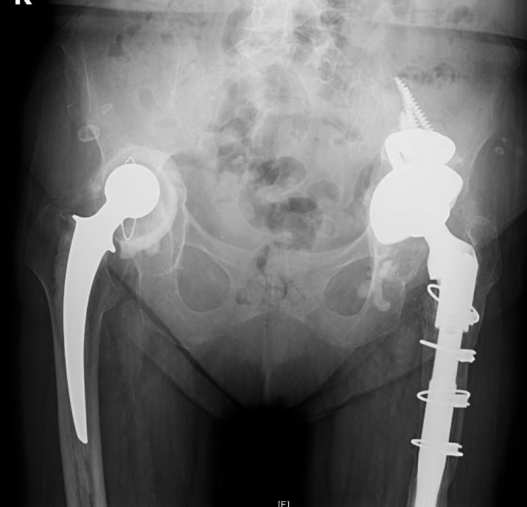 THA Revision for a Paprosky 3B Acetabular Defect – Darwin Chen, MD