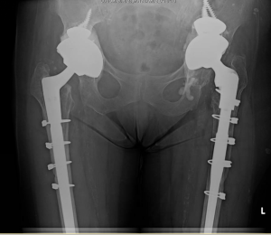 THA Revision for a Paprosky 3B Acetabular Defect – Darwin Chen, MD