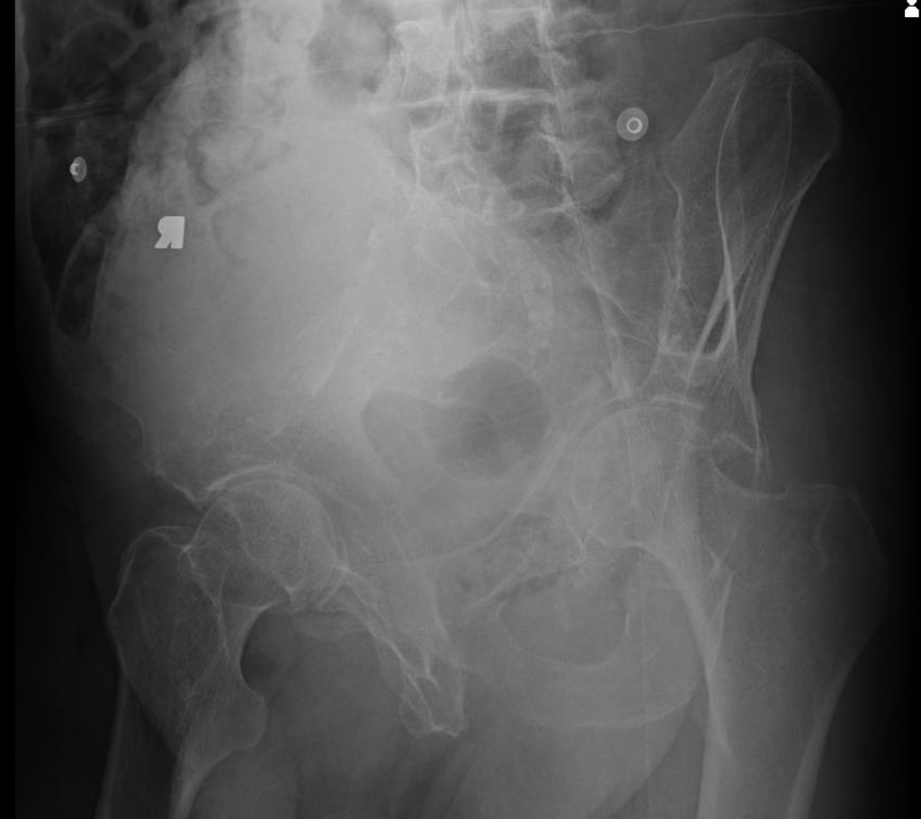 THA for Acetabular Fracture – Darwin Chen, MD