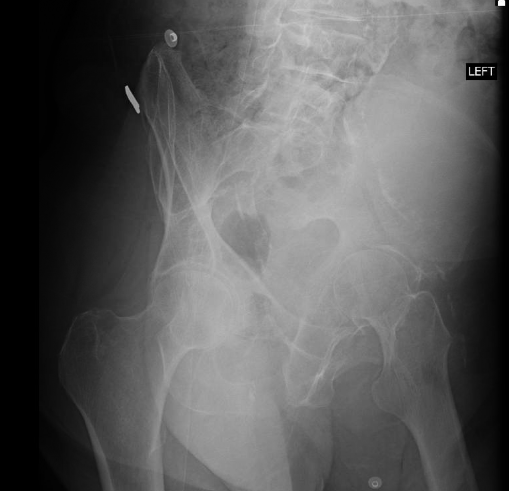 THA for Acetabular Fracture – Darwin Chen, MD