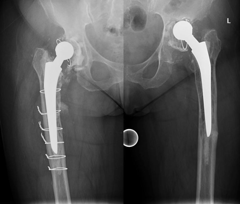 THA revision for loosening and severe bone loss – Darwin Chen, MD
