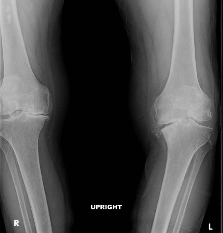 TKA for Severe Varus Deformity – Darwin Chen, MD