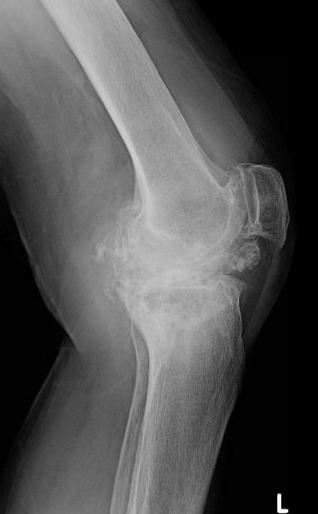 TKA for Severe Varus Deformity – Darwin Chen, MD