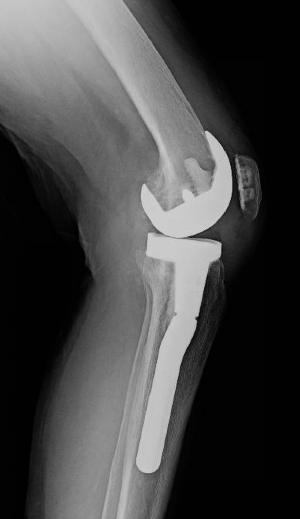 TKA for Severe Varus Deformity – Darwin Chen, MD