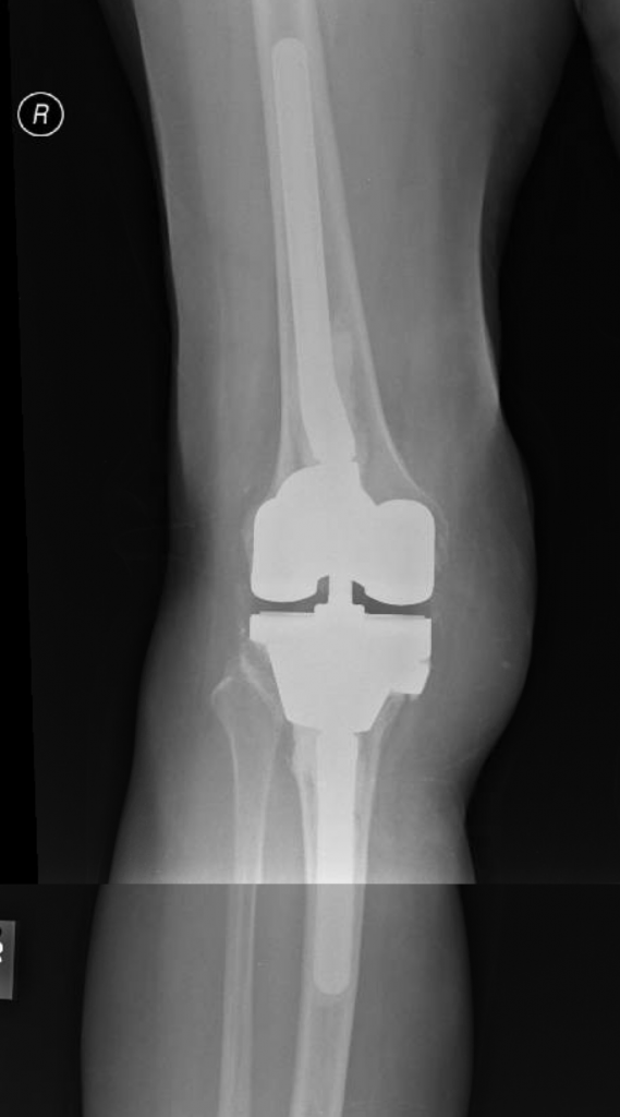 TKA revision for loosening – Darwin Chen, MD
