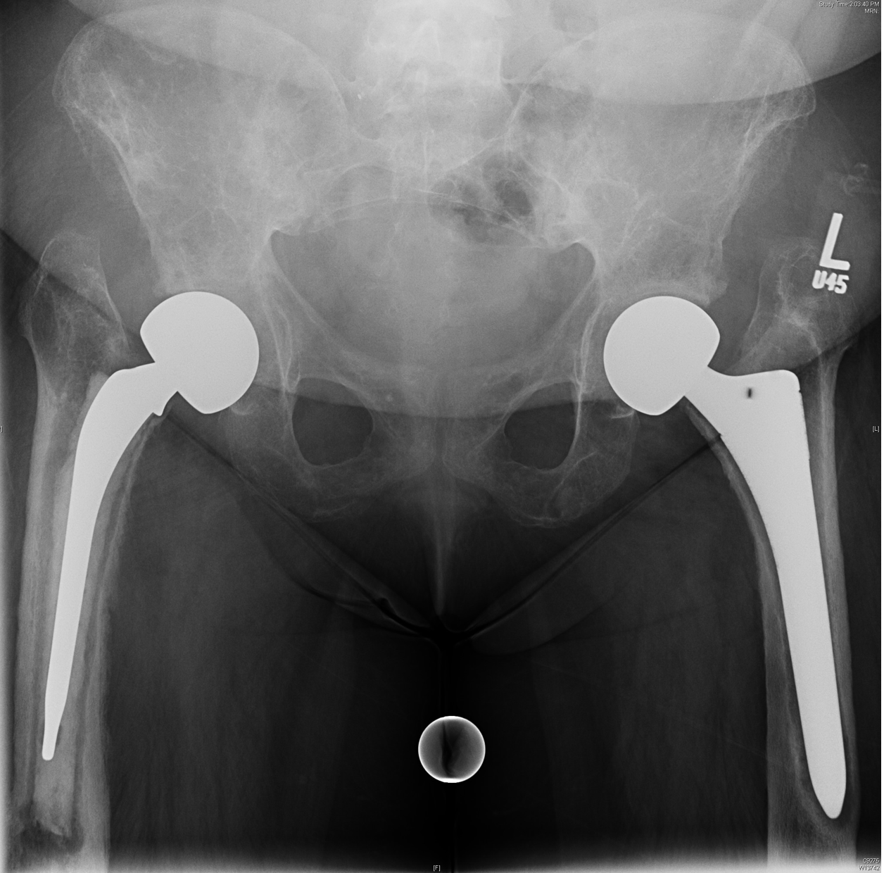 Bilateral THA revision for severe varus remodeling – Darwin Chen, MD