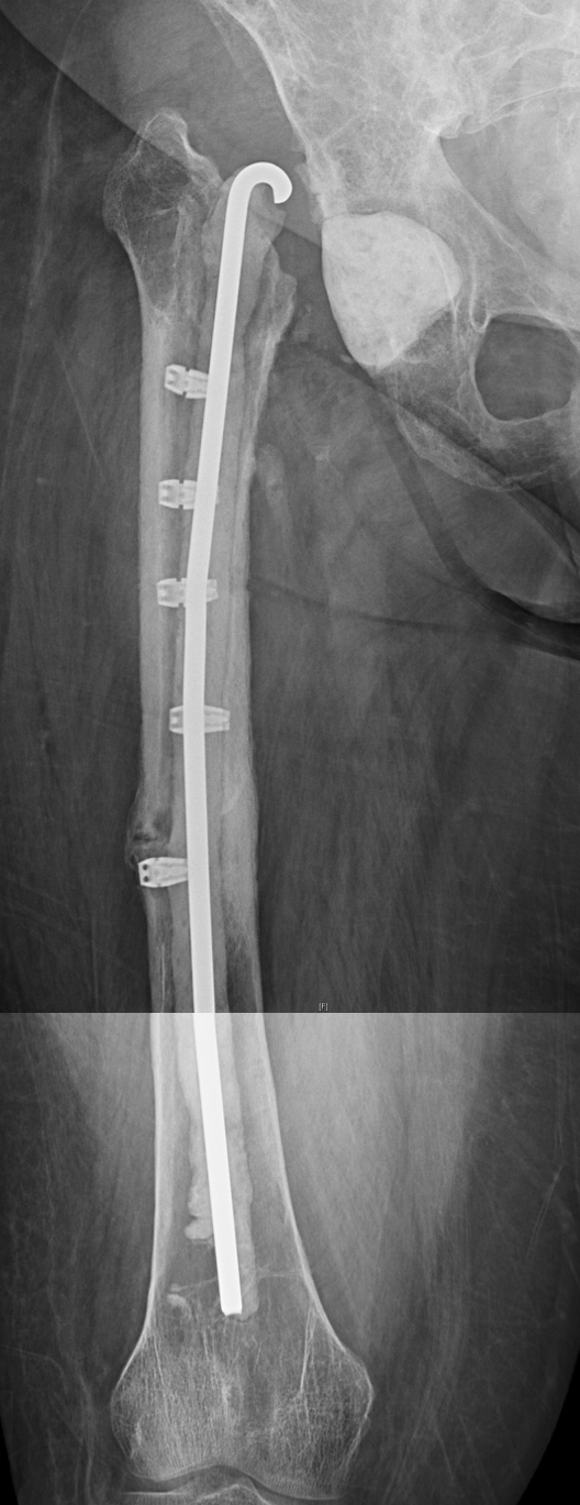 Bilateral THA revision for severe varus remodeling – Darwin Chen, MD