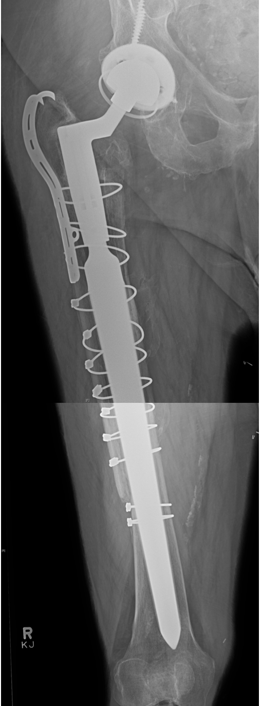 Revision THA for a severe periprosthetic hip fracture – Darwin Chen, MD