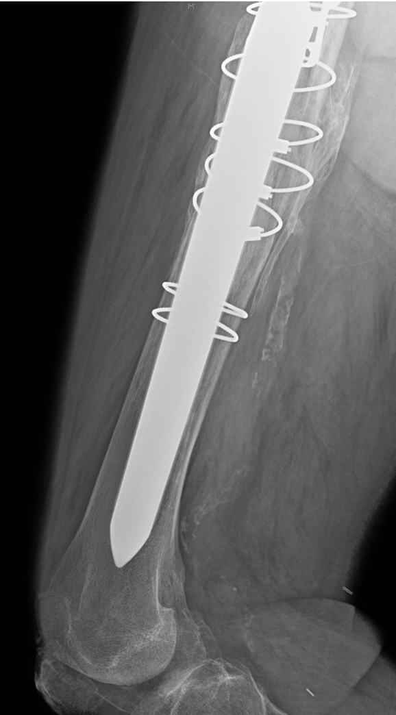 Revision THA for a severe periprosthetic hip fracture – Darwin Chen, MD
