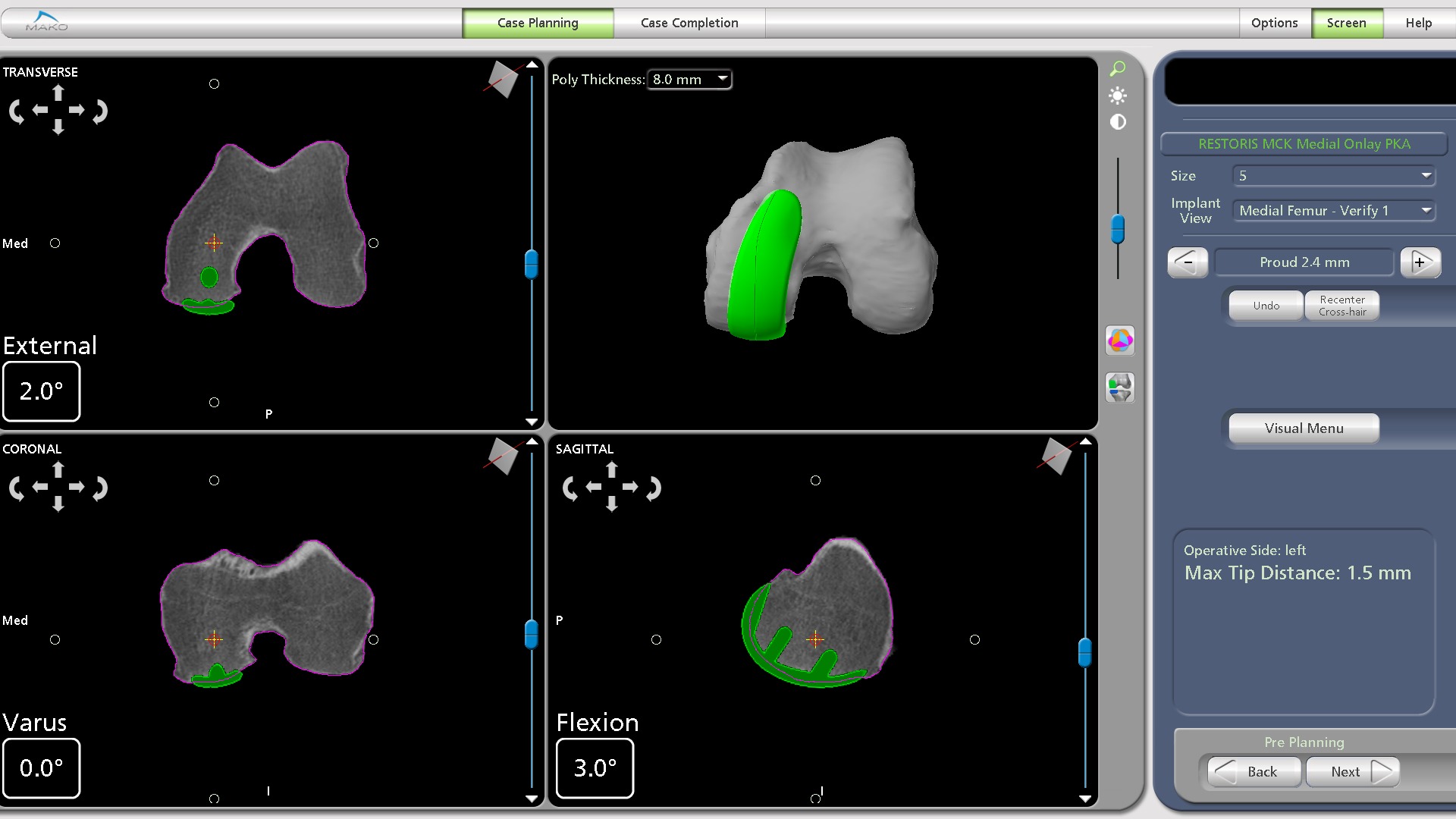 Robotic Assisted Partial Knee Replacement Darwin Chen Md