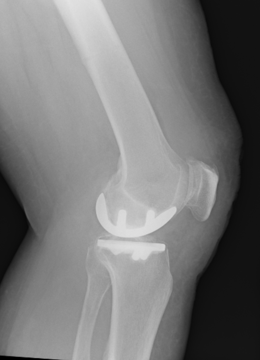 Robotic Assisted Partial Knee Replacement Darwin Chen Md