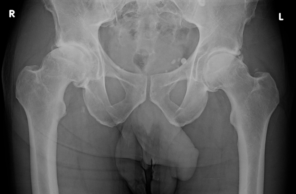 Rapid Recovery, Anterior Approach THA – Darwin Chen, MD