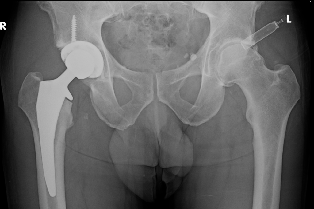 Rapid Recovery, Anterior Approach THA – Darwin Chen, MD